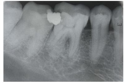 WizDent: Condensing Osteitis