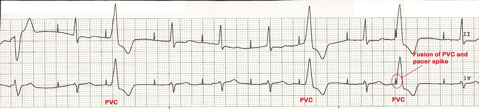EKG Rhythm Strip Quiz 50