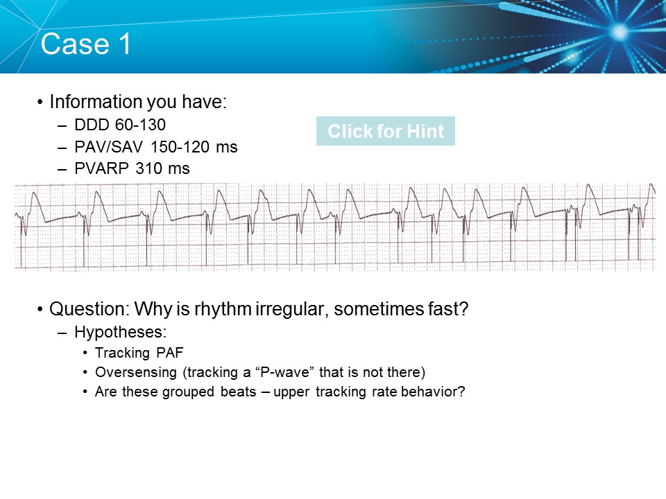 CVT Mohd Farid: Basic Pacemaker Troubleshooting Part I-Medtronic Academy