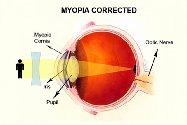 Myopia Control - A Cure For Nearsightedness? - EYE