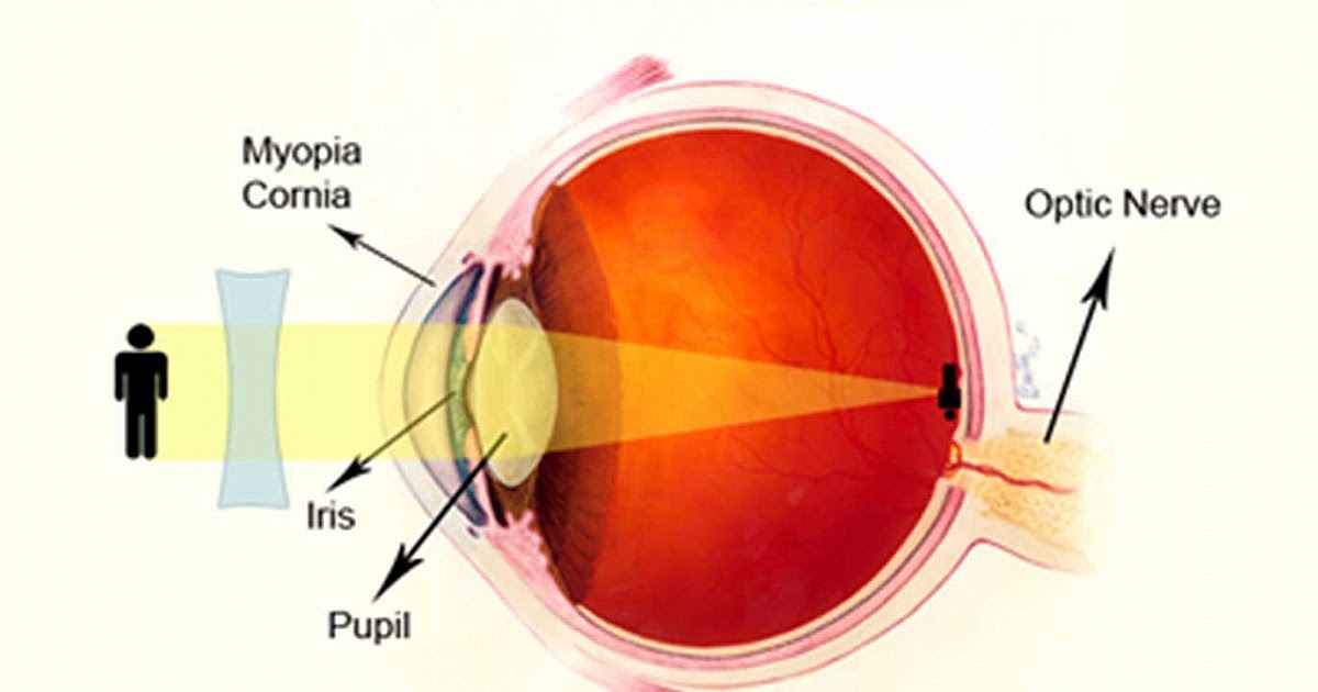 Myopia Control - A Cure For Nearsightedness? - EYE