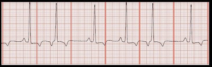 EKG Rhythm Quiz 245