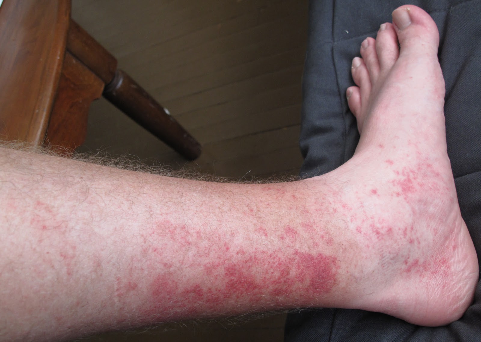 A Journey Of Stroke Recovery Discoloured And Swelling