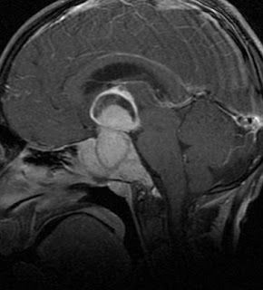 Clival Invasion in Pituitary Macroadenoma-MRI - Sumer's Radiology Blog