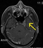 Possible Tolosa Hunt Syndrome - Sumer's Radiology Blog