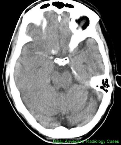 Dr Balaji Anvekar FRCR: Hyperdense MCA sign