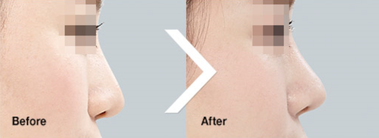 ID Hospital Korea: [ID hospital] What is nose revision?