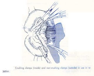 OTMANAGE: BOWEL RESECTION Procedure 6