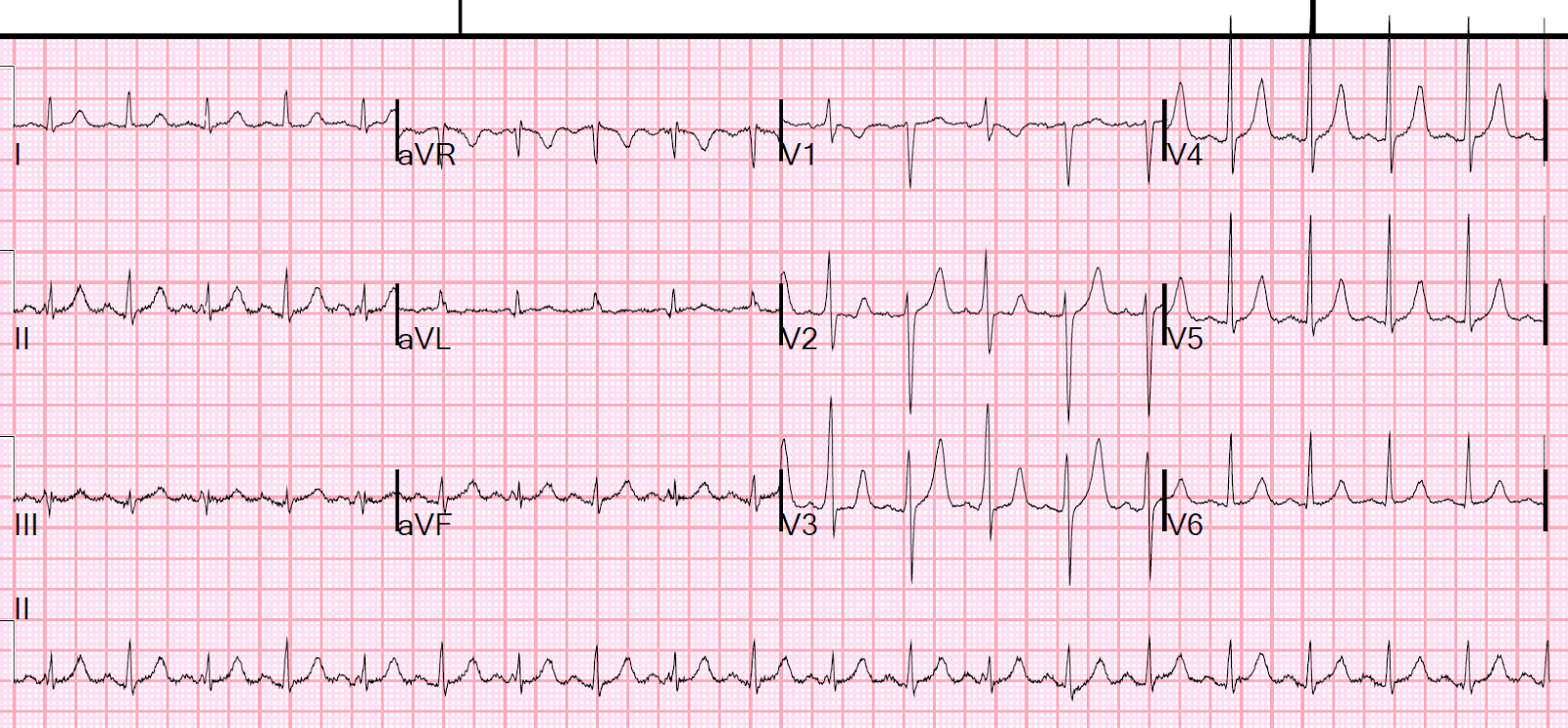 Dr. Smith's ECG Blog: Tachycardia, Dehydration, and New ST Elevation in ...