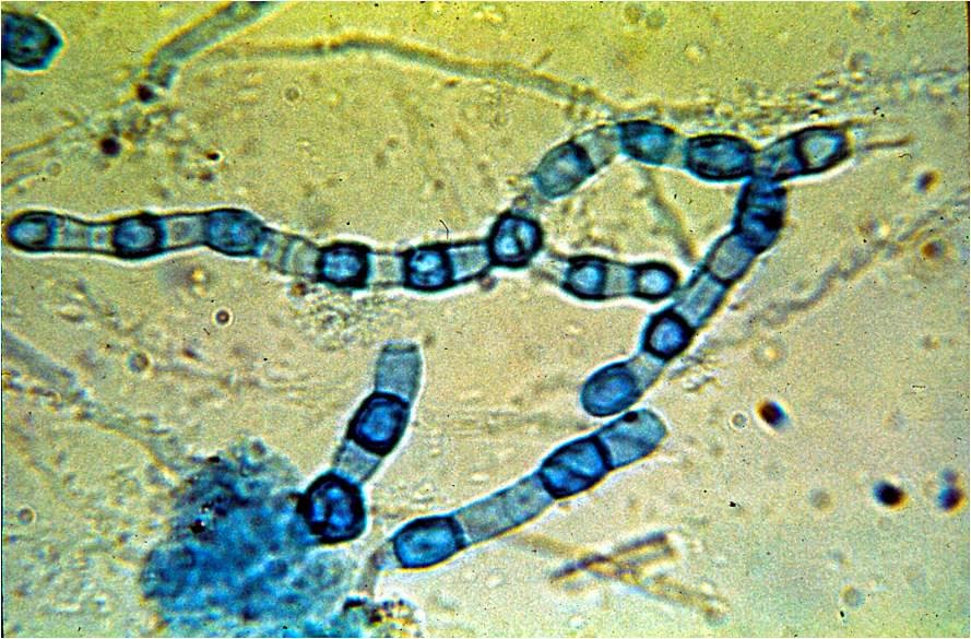 MEDICINA TRADICIONAL CHINA: ENFERMEDADES CAUSADAS POR HONGOS TIÑA o TINEA