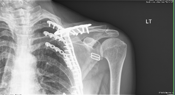 TITANIUM RIB PLATING: RECOVERY
