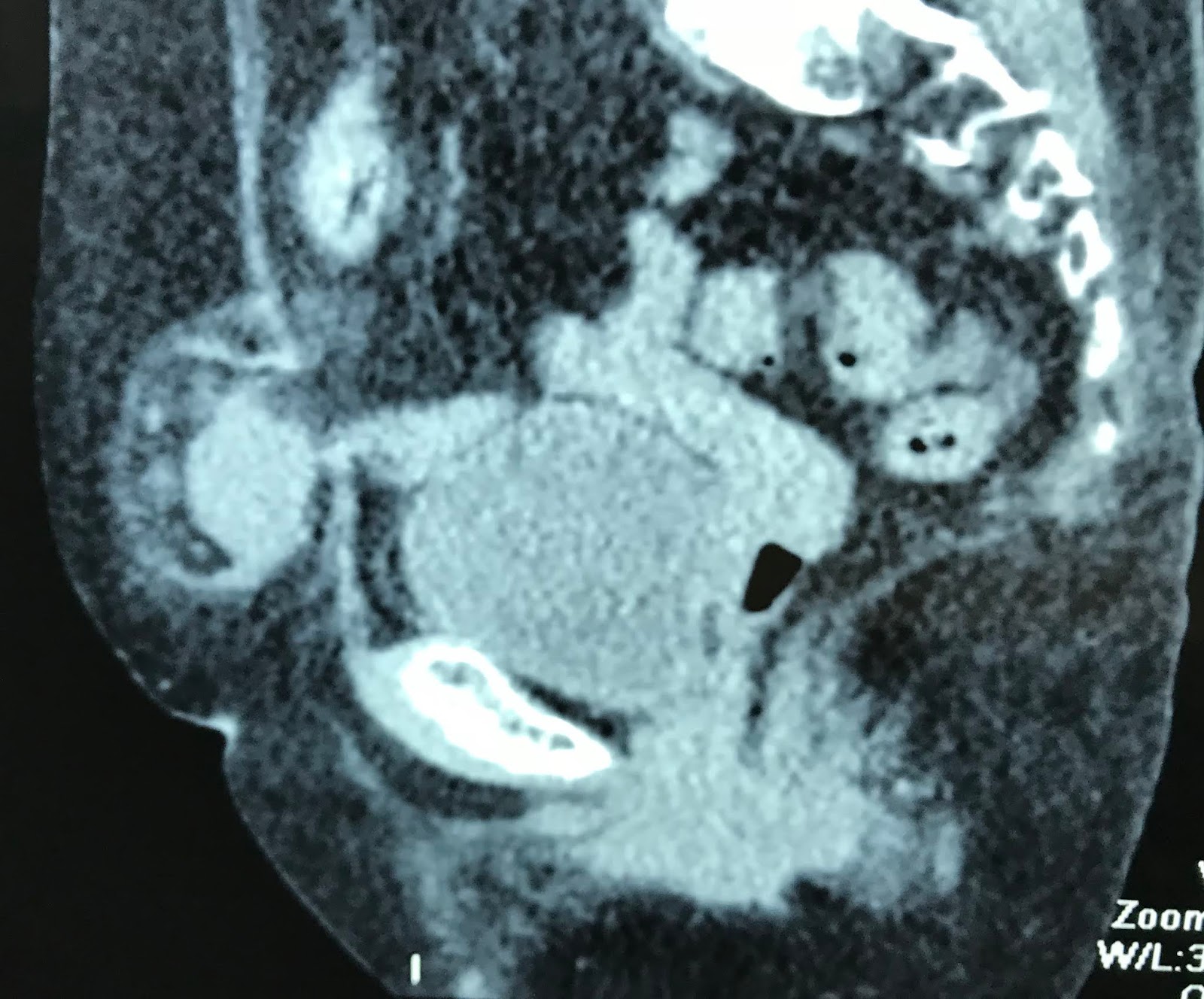 Ventral Hernia Ultrasound