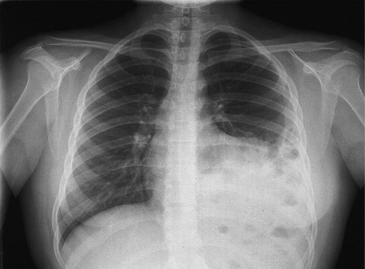 MUNDO ENFERMEDADES: DIAGNÓSTICO DERRAME PLEURAL