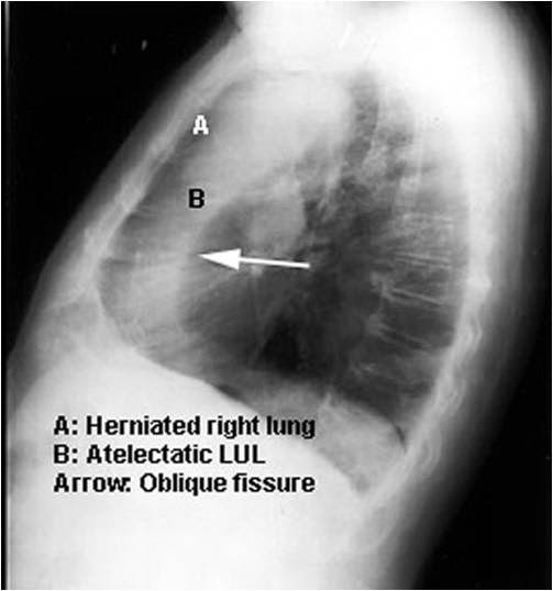 RADIOLOGY IMAGE SPOTTERS: Left upper lobe collapse