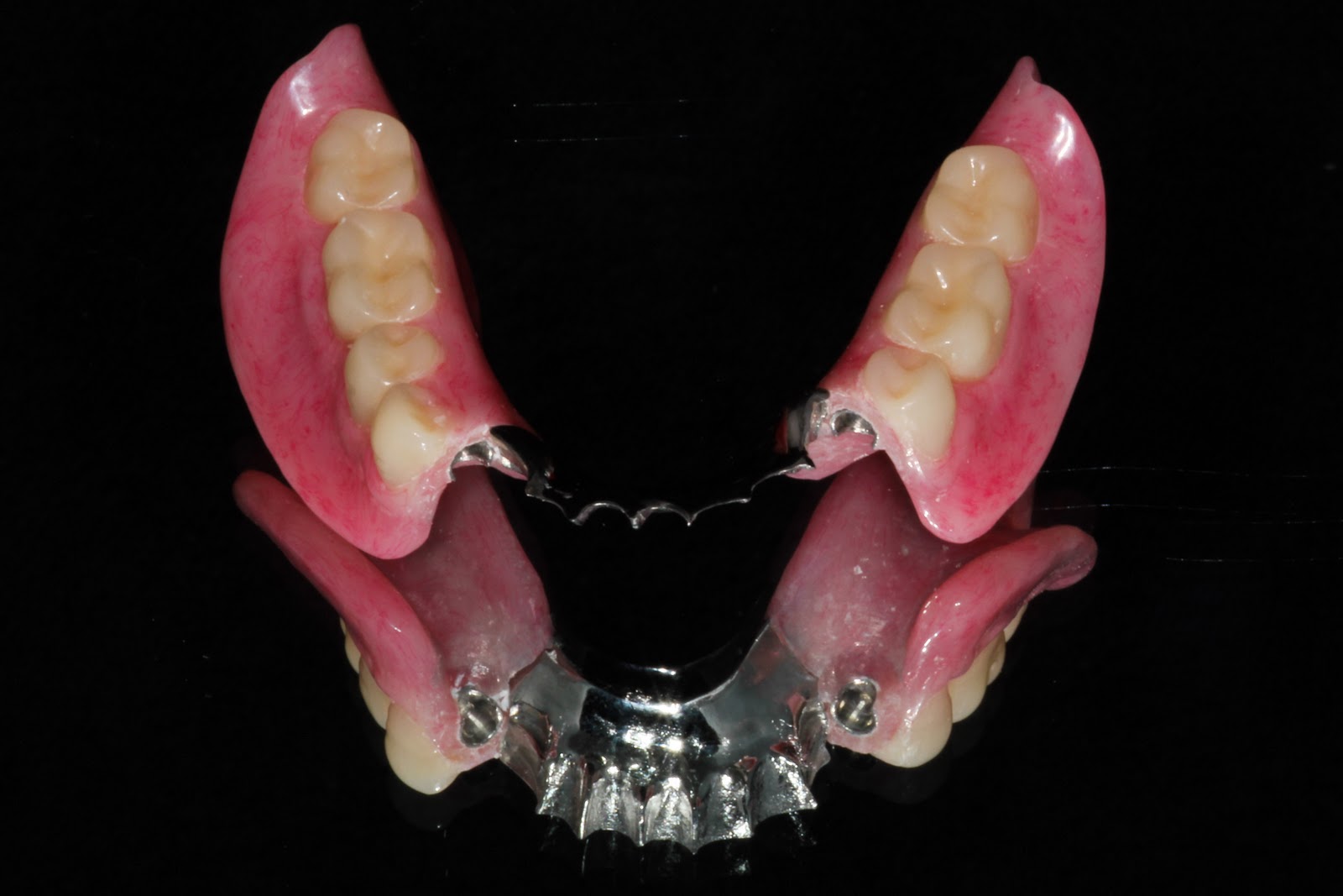 Boise Idaho Prosthodontics: Semi-Precision attachment RPD - 3 different ...