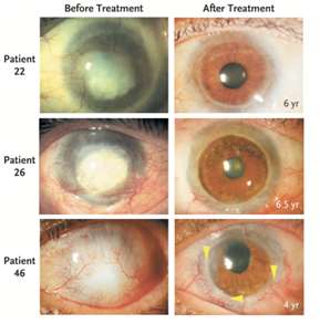 Radiation Awareness: Radiation damage to the eye