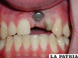 Abscesos orales y sus peligros | Odontologia Preventiva