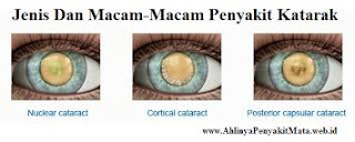 E-BOOK SURGICAL: KATARAK