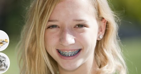 The differences between Roth, MBT and Edgewise brackets ~ PlusDent ...