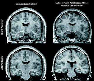 Psychiatry and Society in Pune: Neurotoxic effects of alcohol on the ...