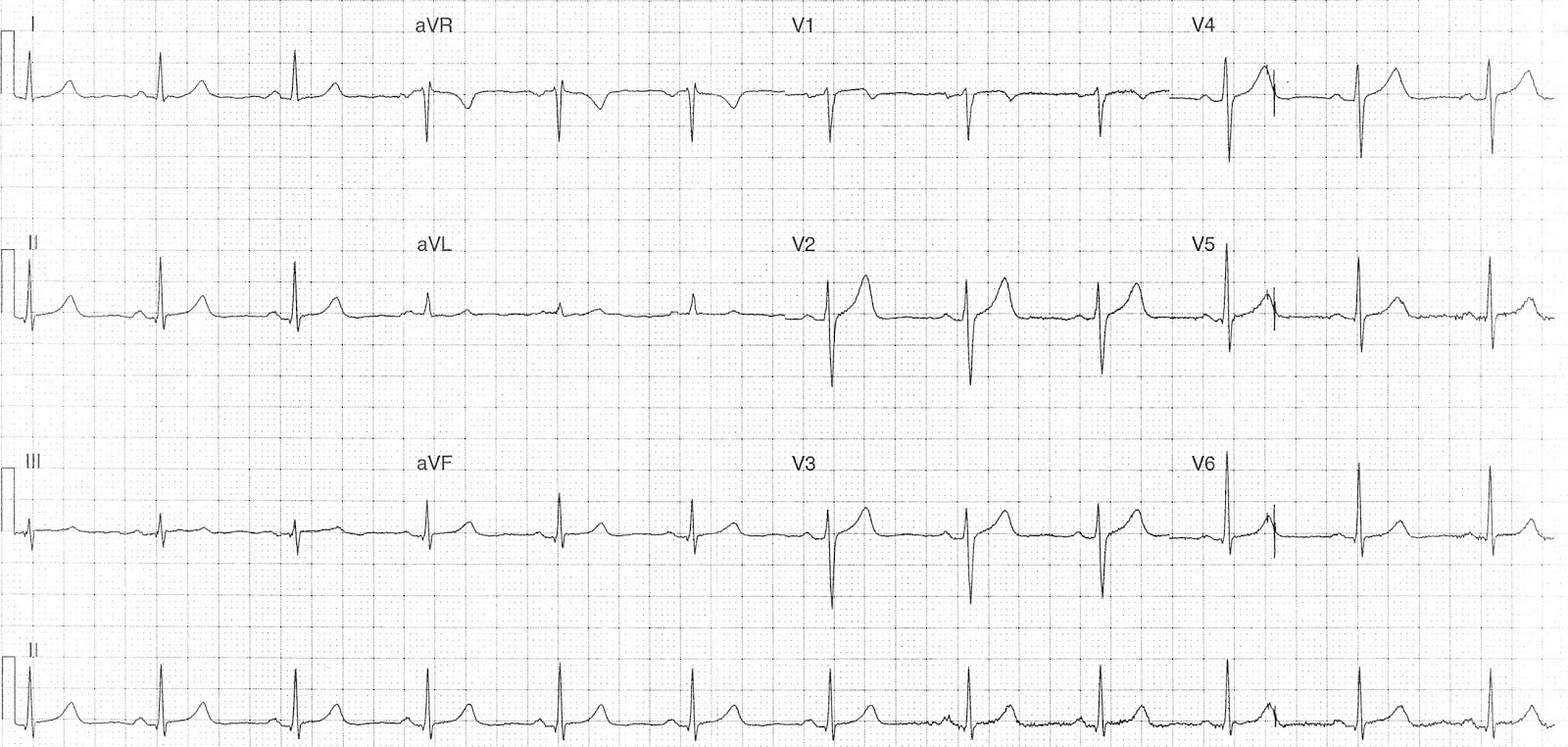 ECG of the Week: ECG of the Week - 30th November 2015