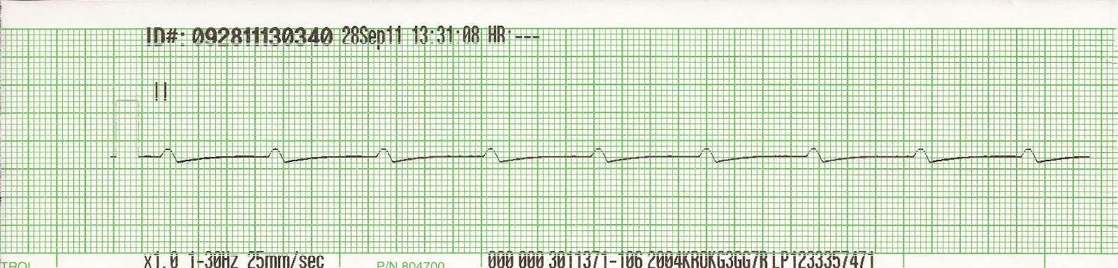 Float Nurse: EKG Rhythm Strip Quiz 86