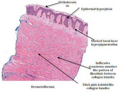 Dermpath Made Simple - Neoplastic: Dermatofibroma