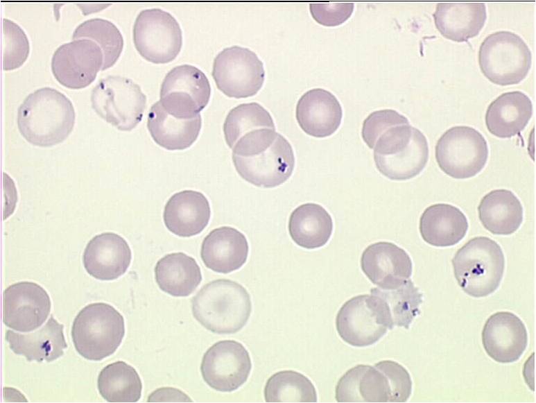 Doença de Crohn: novas perspectivas: Alterações da eritropoiese ...