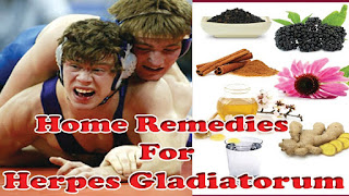 Herpes gladiatorum
