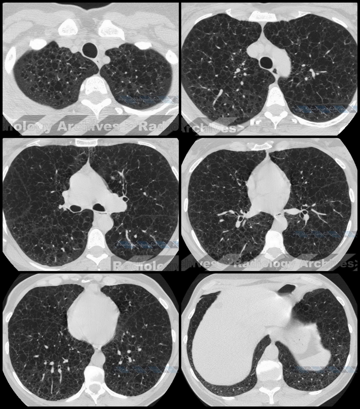 Radiology Archives: Λεμφαγγειολειομυομάτωση