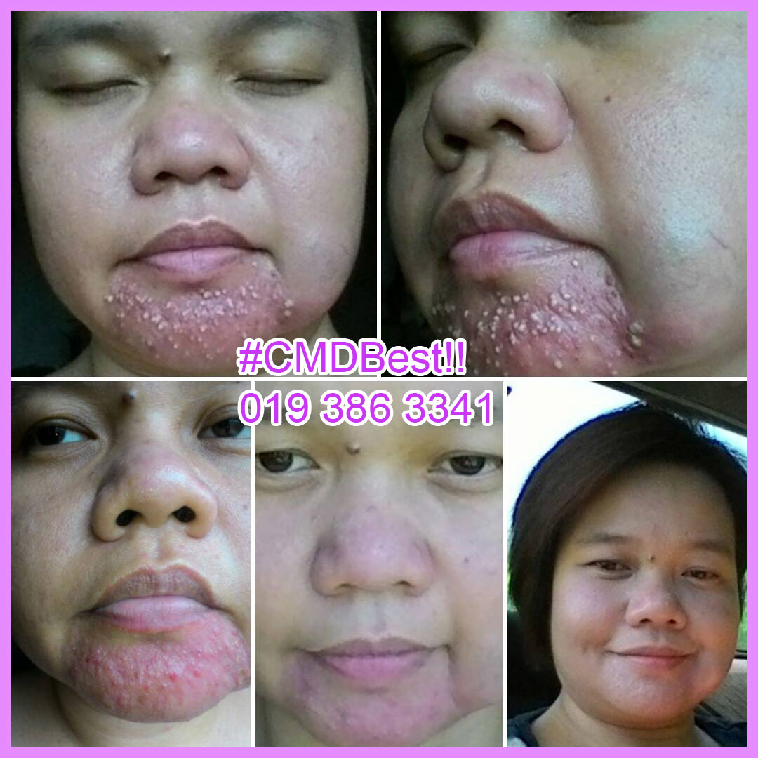 D'ManissFavorite~CMDonline: Apa tu Sebaceous Cyst?? Resdung Berjerawat ...