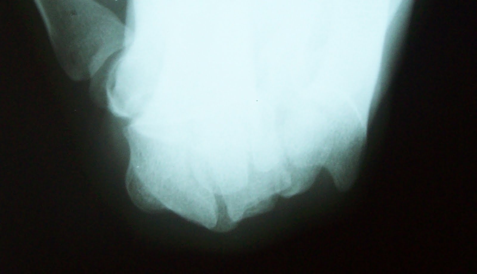 Rx011: Proyecciones Canal Carpiano