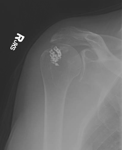 Shoulder and Elbow Surgery: Surgical treatment options for massive ...