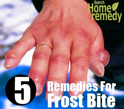 TOP 5 HERBAL REMEDIES FOR FROST BITE ~ Mzizi Mkavu