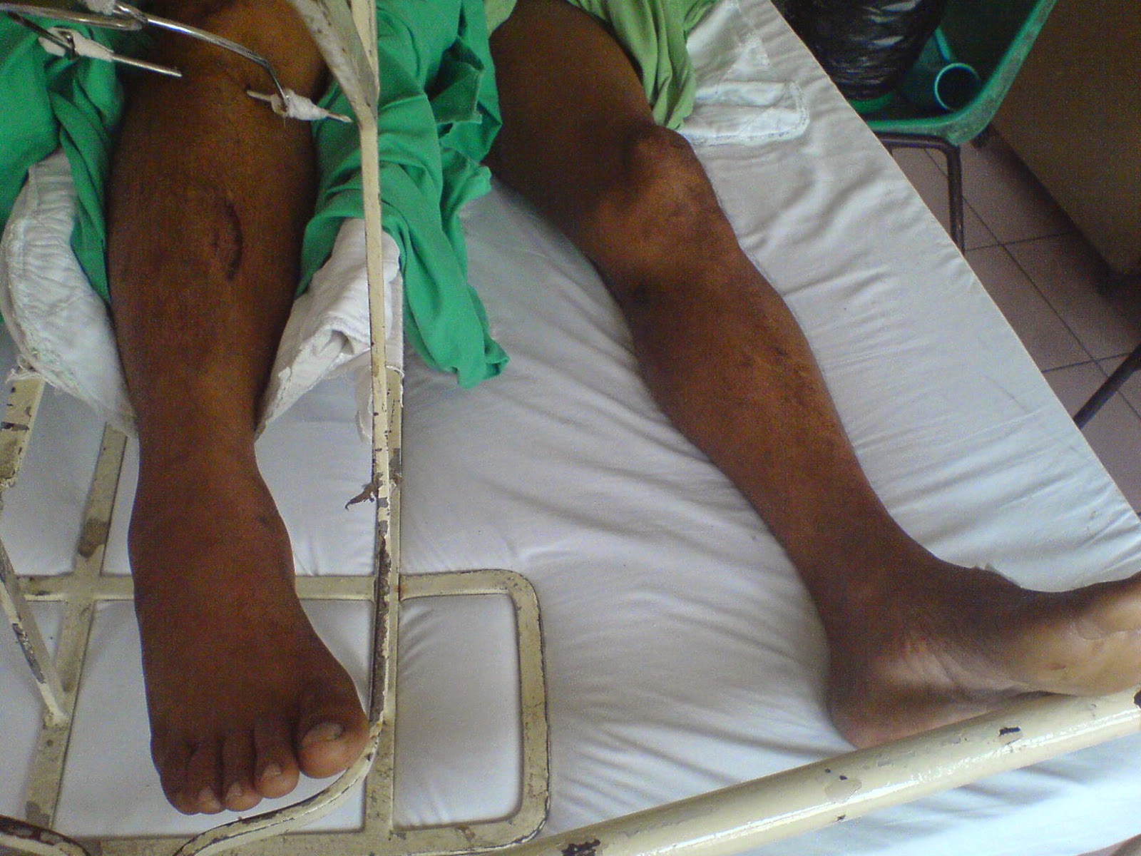Medical & Beyond: CASE WRITE UP : FRACTURE SHAFT OF FEMUR