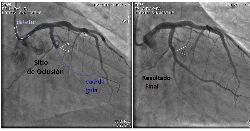 TAC de Pulmón y Angiografía Coronaria : Angiografia Coronaria