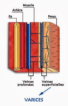Blog 75: Infos santé-Varices