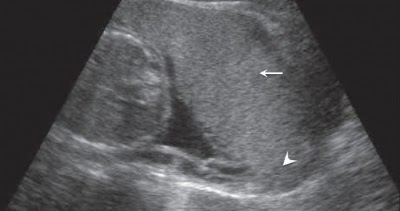 Battledore Placenta - Definition, Complications, Pictures, Causes ...