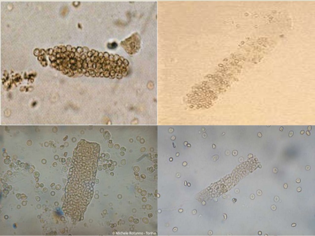 Examen de orina: Cilindros