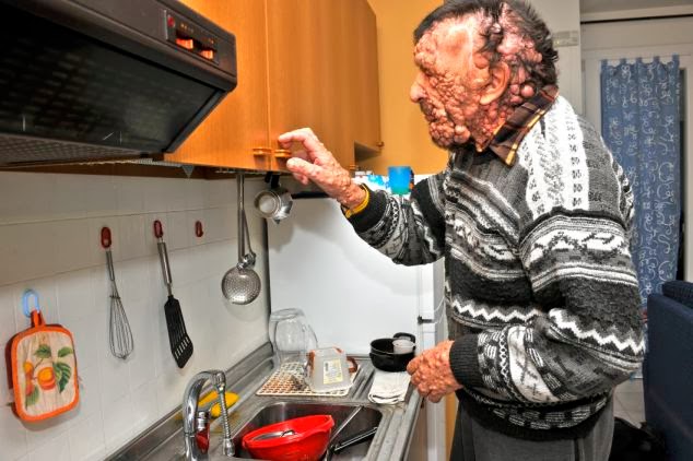 Manny360: [FULL PHOTOS] Disfigured Man who was Held and Kissed by Pope ...