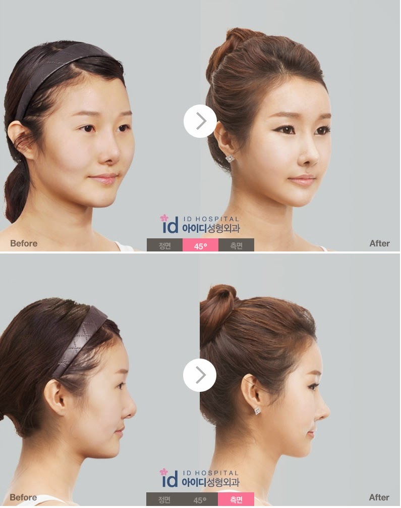 ID Hospital Korea: A Perfect Nose Profile - Barbie-line Rhinoplasty
