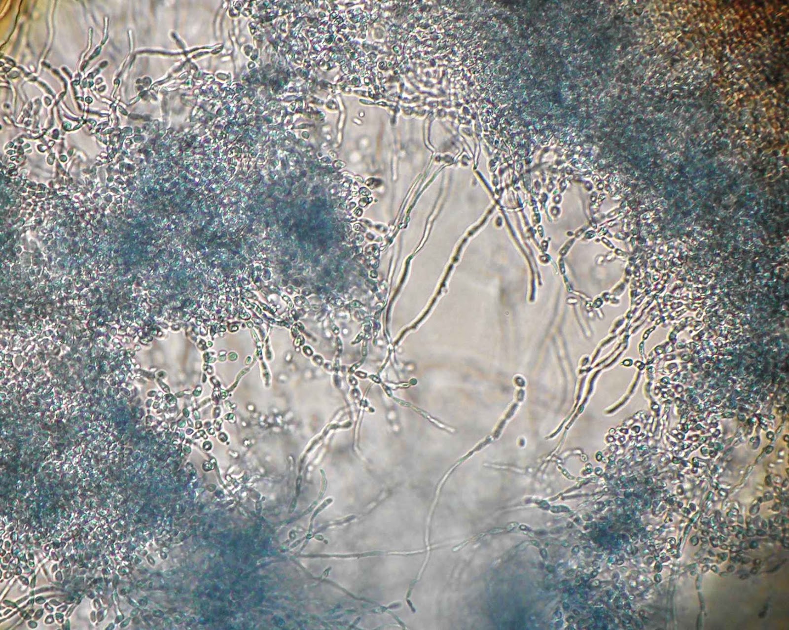 ATLAS MICOLOGIA: EXOPHIALA DERMATITIDIS