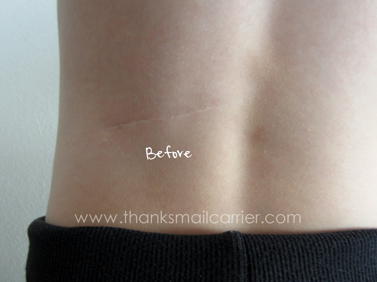 Thanks, Mail Carrier | Mederma Advanced Scar Gel {Review & Giveaway - 5 ...