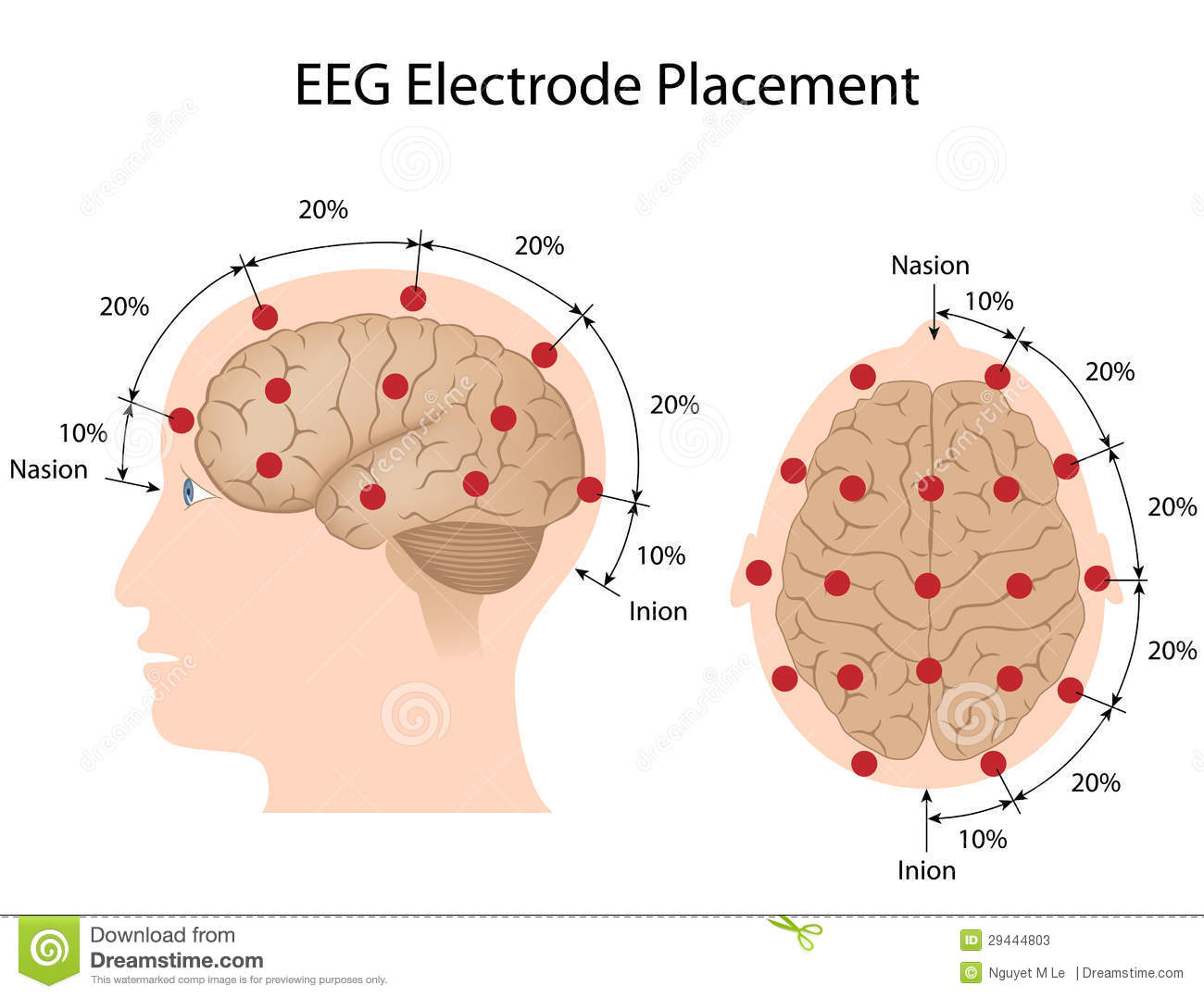 Fun with SATB2 Associated Syndrome : 3 Day EEG