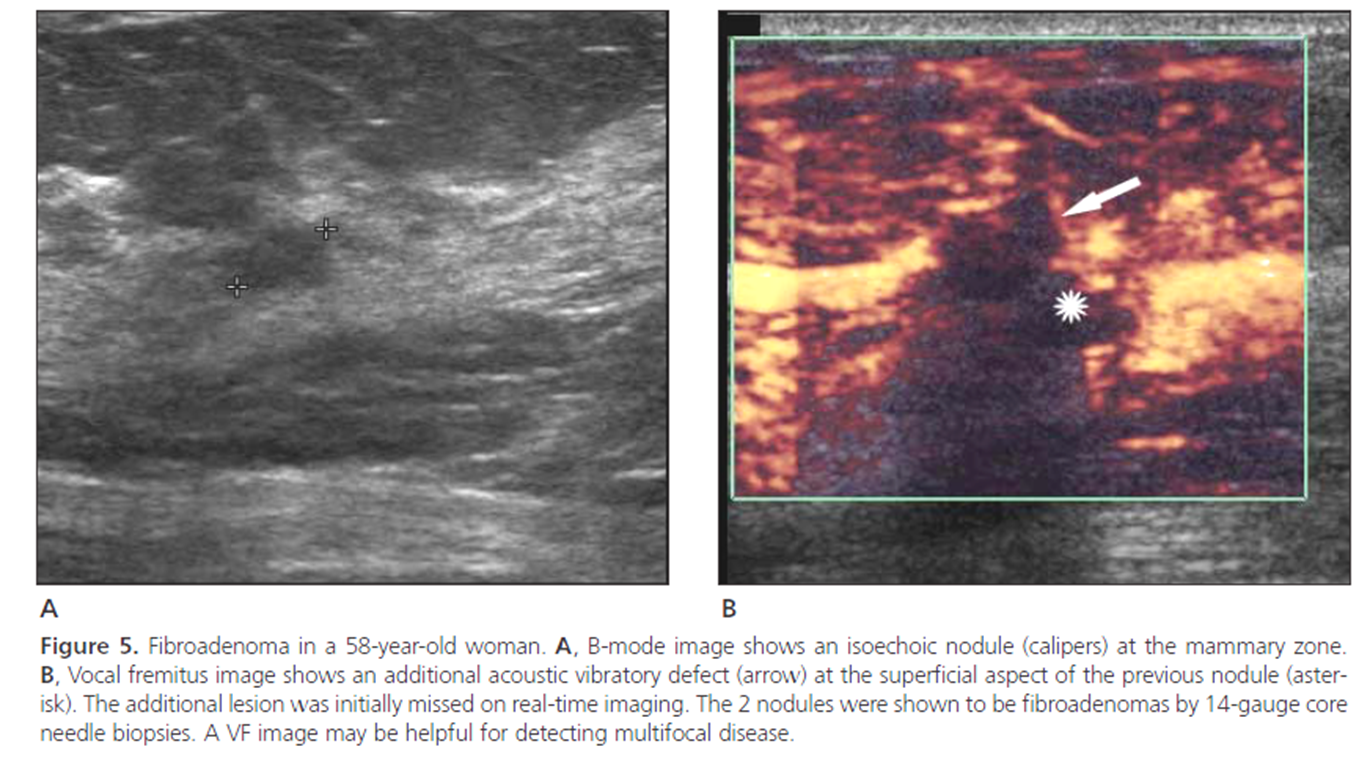 BÀI SOẠN VỀ SIÊU ÂM CHẨN ĐOÁN: VOCAL FREMITUS in BREAST COLOR ...