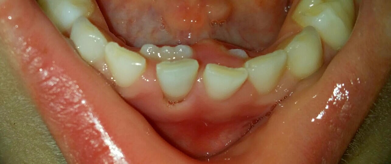 Mother of a Toddler and Triplets Plus ONE: Ava lost her 1st tooth today ...