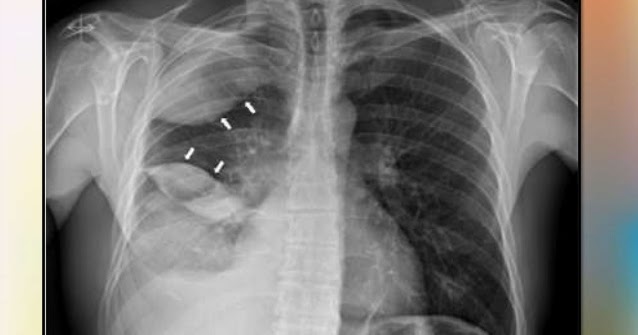 What Is Empyema? - Teroes