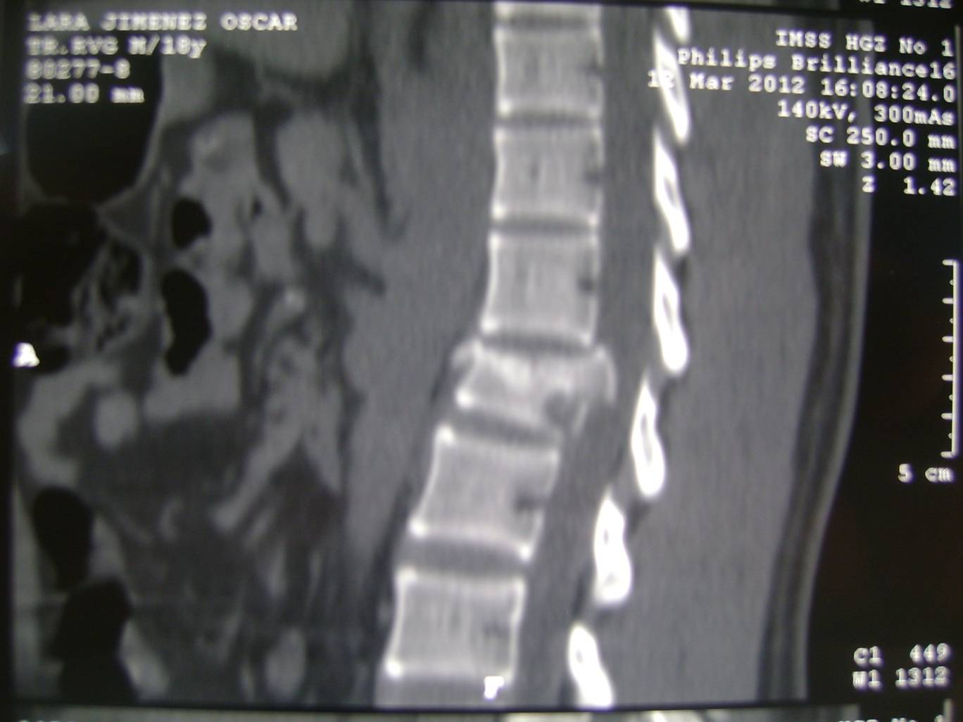 O R T O C R I T I C A: Fractura compresion L1 Frankel E en paciente joven