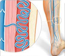 Les varices | Maladies Cardio-vasculaires