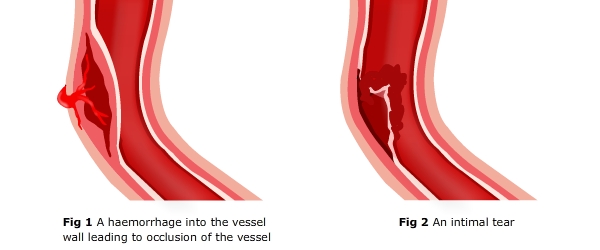 Γνωρίζετε ότι μπορεί να προκληθεί εγκεφαλικό από άτσαλο μασάζ στον ...